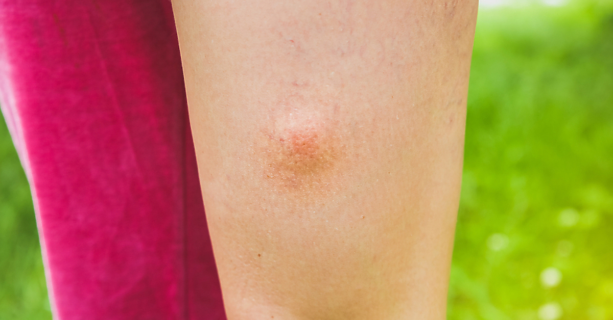 Kako tretirati ubod od ose, šta trebate uraditi