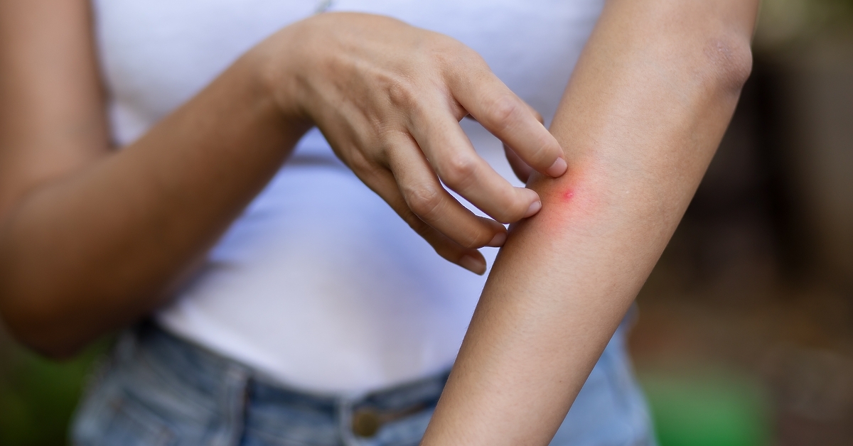 Znate li zašto ne osjetite ubod komarca