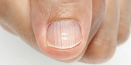 Vertikalni nabori na noktima: Uobičajena pojava ili znak zdravstvenih problema?