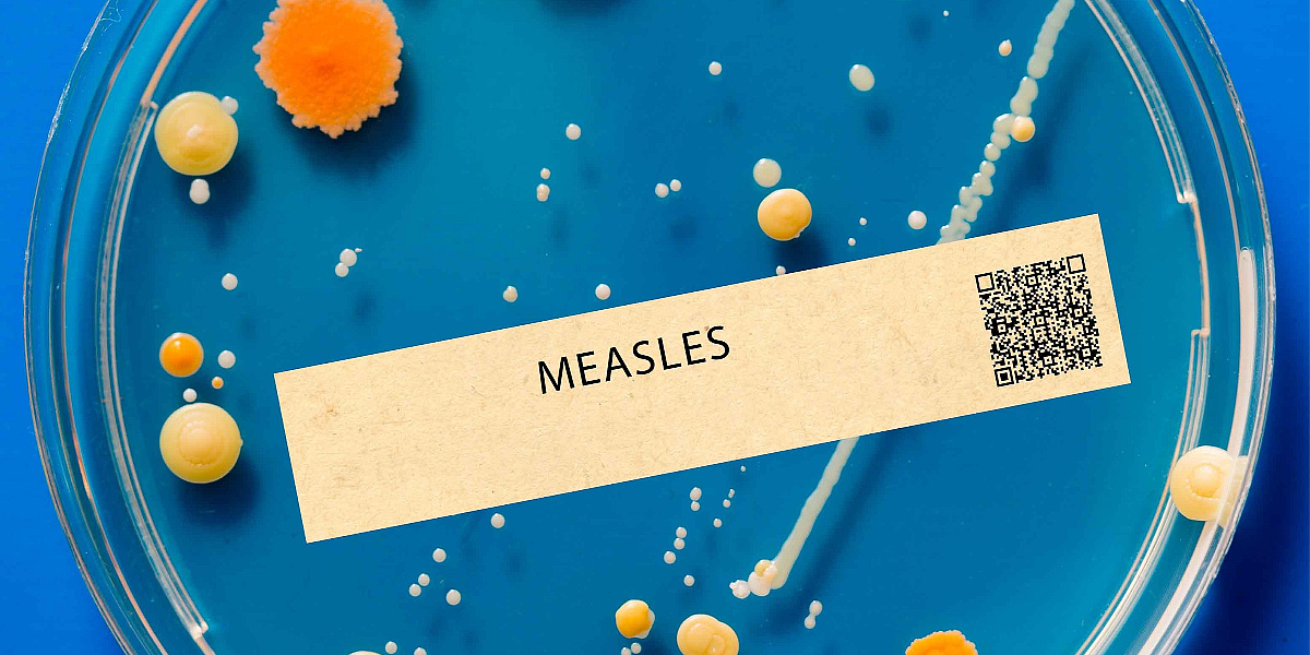 Evropa bilježi najveći broj slučajeva morbila od 1997. godine ...